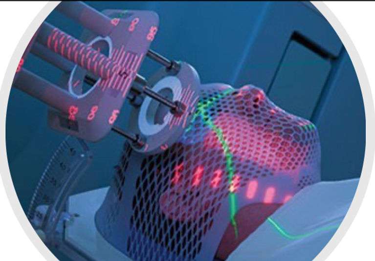 Radiation Fibrosis Syndrome – Causes, Effects & Physiotherapy